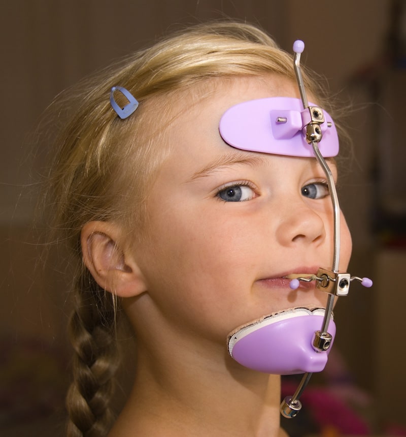 Headgear | Wilmington Orthodontics